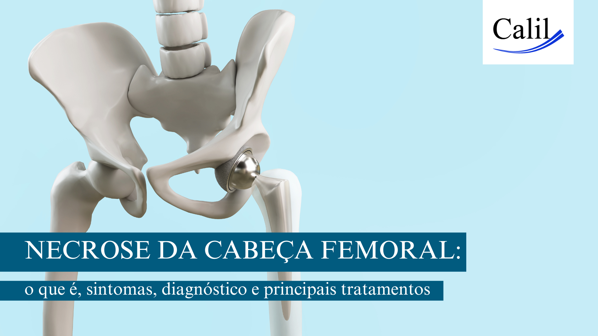 Necrose da cabeça femoral: o que é, diagnóstico e tratamentos