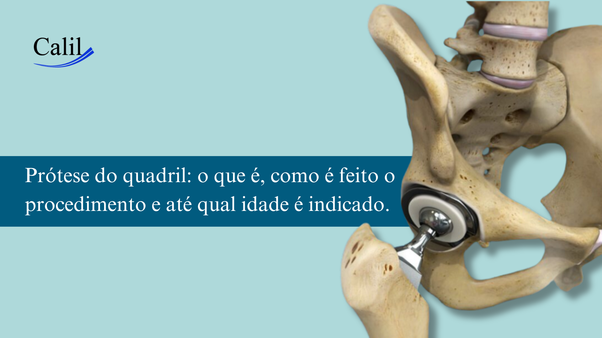 Prótese do quadril: o que é, como é feito o procedimento e até qual ...